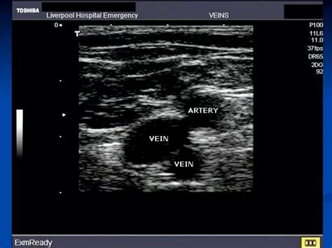 5 Scanning For Dvt Pdf