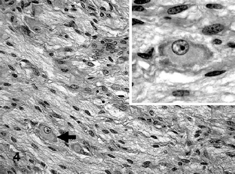 Jejunum Bovine Schwannian Stroma Dominant Tumor Area With Few Download Scientific Diagram