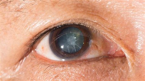What Is A Cortical Cataract Symptoms Causes And Treatment