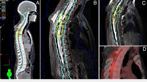 A Treatment Planning Ct Sagittal View Displaying Total Craniospinal Download Scientific