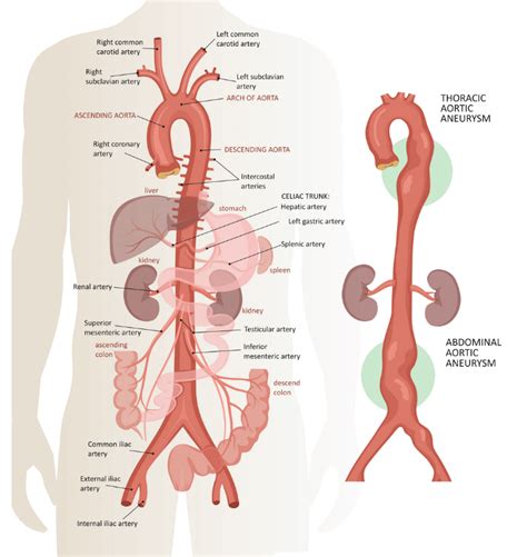 Aortic Aneurysm Aaa And Dissection Evar Tevar Dr Rutvij