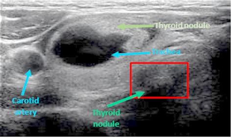 Automated Thyroid Nodule Classification In Ultrasound Imaging Using A Hybrid Vision Transformer