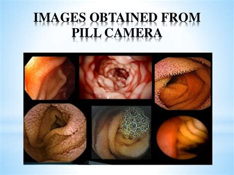 Pill Camera