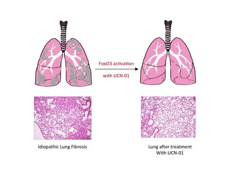 Pulmonary Fibrosis Guidelines 2024 Vuxf