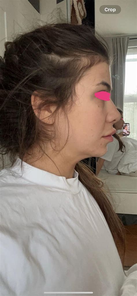 3 Months Post Chin Lipo R Plasticsurgery