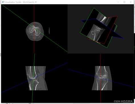 三维重建 Pyqt Python Mpr 四视图（横断面，冠状面，矢状面，3d