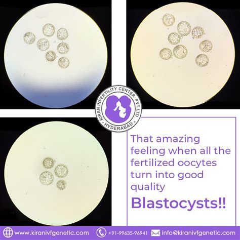 When All The Fertilized Oocytes Turn Into Good Quality Blastocysts