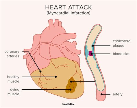 Heart Attack Symptoms Causes Diagnosis Prevention More