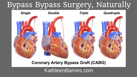 Bypassing Bypass Surgery Naturally