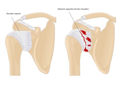 Frozen Shoulder And Calcific Tendonitis Of The Shoulder Both Helped