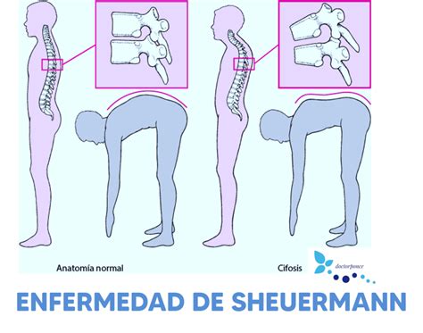 Enfermedad De Scheuermann Clínica Reumatológica Doctor Ponce