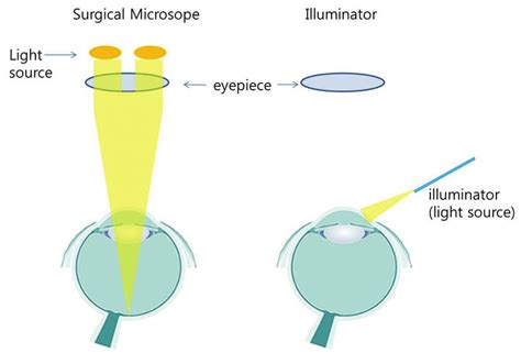 Schematic Diagram Of Conventional Surgical Microscope And Illuminator
