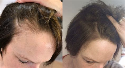 Female Hair Loss Solutions Mhr Clinic Hair Restoration Specialists