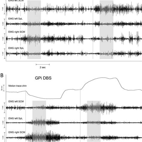 Raw Data Of A Sequence Of Horizontal Head Rotation A Preoperatively And