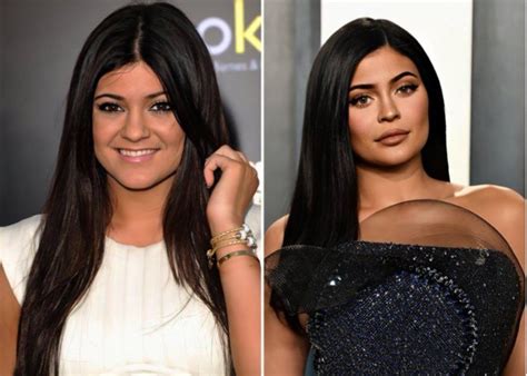Kylie Jenner Before And After Plastic Surgery Gbsoru