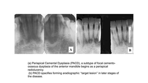 Cemento Osseus Dysplasia Doctor Faris Alabeedi Msc Mmedsc Pgdip Bds