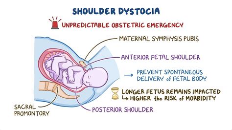 Shoulder Dystocia Video And Meaning Osmosis