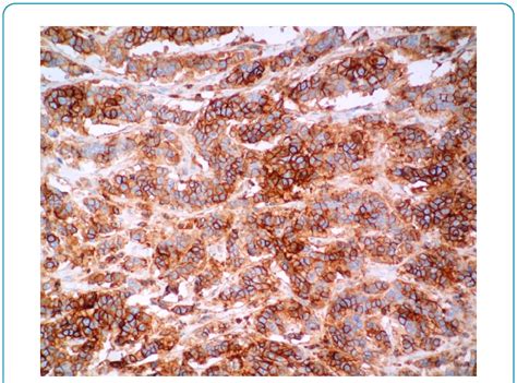Cd 56 Stain Show Diffuse Strong Cytoplasmic Staining Download Scientific Diagram