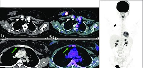 Three Dimensional Maximum Intensity Projection A Axial Ct And Axial Download Scientific