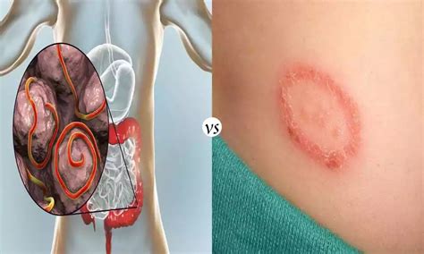 Difference Between Pinworm And Ringworm