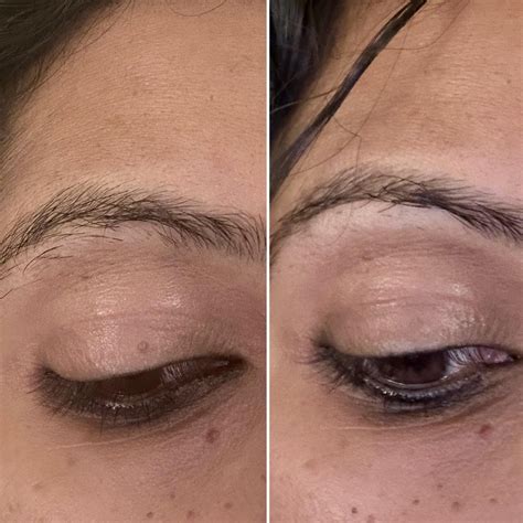 Stubborn Milia On Eyelid Went Away Rcanskincare