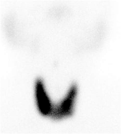 Diagnosis Of Graves Disease During Treatment For Subacute Thyroiditis