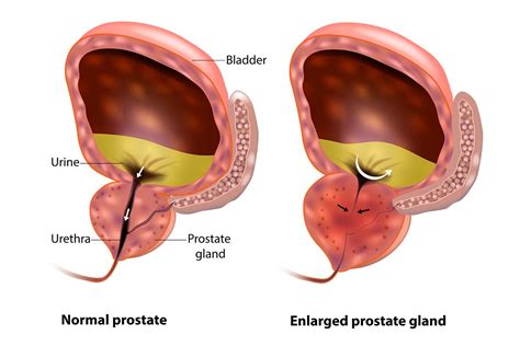 Benign Prostatic Hyperplasia Mens Health A Z Canadian Mens Health Foundation