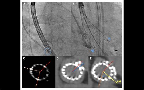 New Feature Found On Evolut Fx Valve Helps Cardiologists Confirm