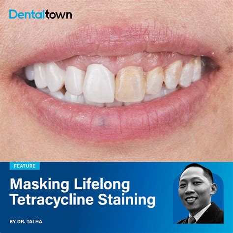 Masking Lifelong Tetracycline Staining By Dr Tai Ha Dentaltown