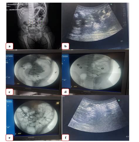 Effects Of General Anesthesia On The Success Rate Of Pneumatic