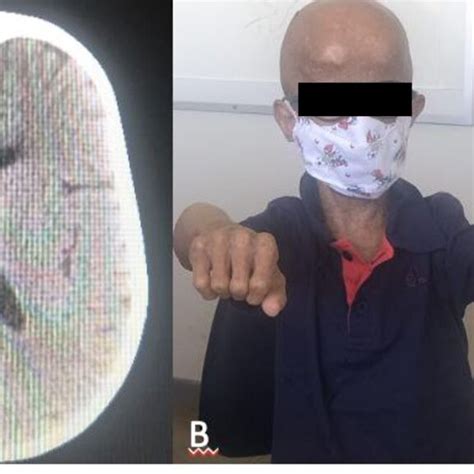Ct Scan One Day After Surgery Showing A New área Of Ischemia At The