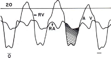 Figure 3 From Right Sided Gram Negative Endocarditis After Intravenous