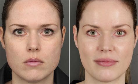 Lip Enhancement Monaz Clinic London
