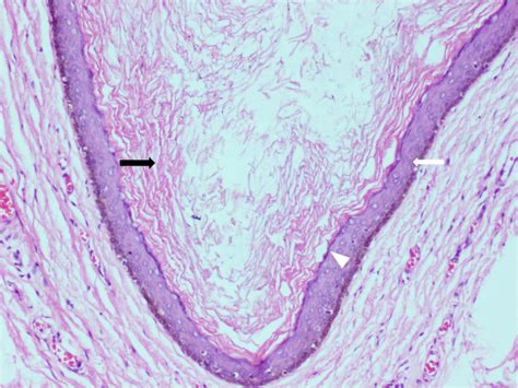 Sebaceous Cyst Histology At Spencer Erlikilyika Blog