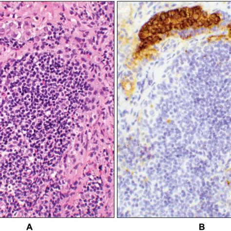 Metastasis A Sentinel Lymph Node With A Metastatic Carcinoma Case