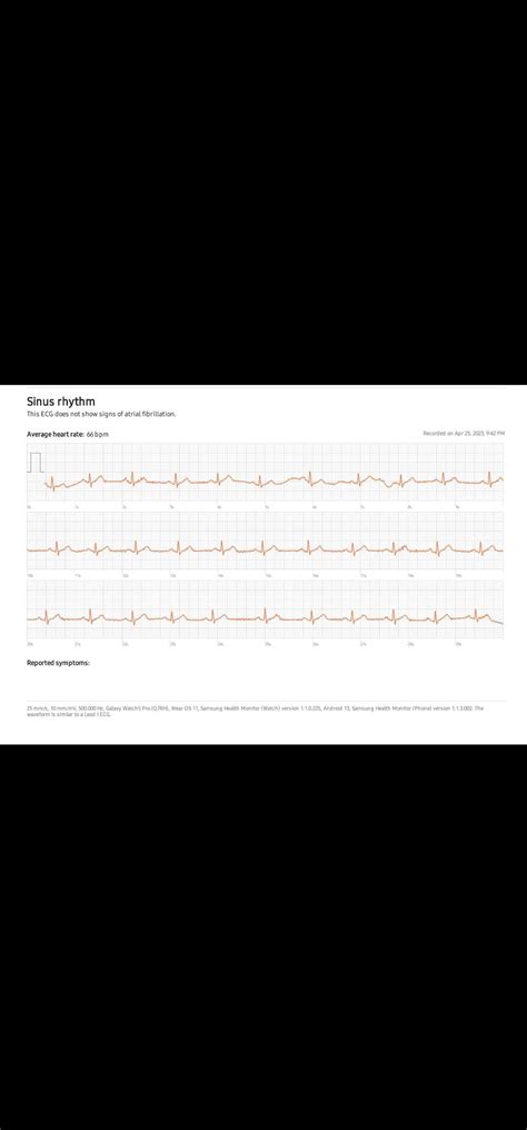 arterial flutter or artifact r readmyecg