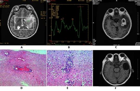 Retrospective Analysis Of 28 Cases Confirmed For Primary Angiitis Of The Central Nervous System
