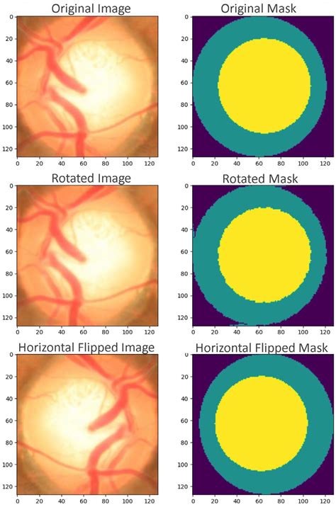 Optimizing Glaucoma Diagnosis With Deep Learning Based Segmentation And Classification Of