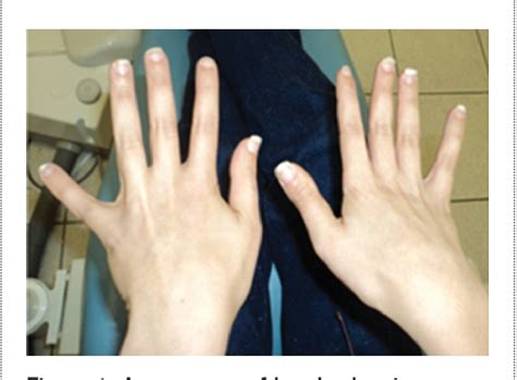 Figure 1 From Dental Treatment Of A Patient With Opitz Gbbb Syndrome