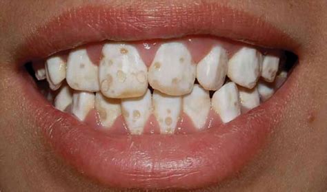 Hypoplasia Of Enamel Definition Of Hypoplasia Of Enamel