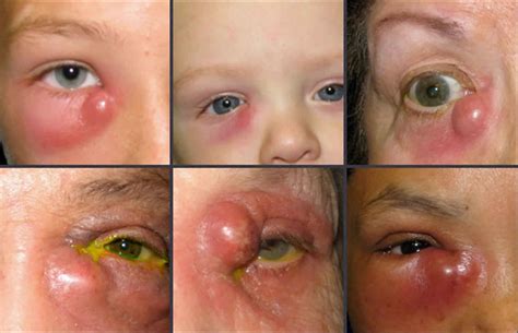 Dacryocystitis Causes Symptoms Diagnosis And Dacryocystitis Treatment