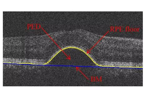 Pigment Epithelial Detachment Ped Pptx