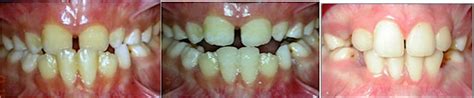 Early Treatment Of Anterior Crossbite Relating To Functional Class Iii