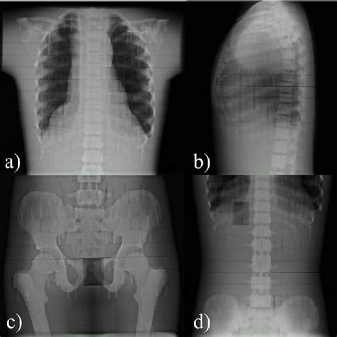 Imaged Area In A Chest Pa B Chest Lat C Pelvis Ap And D