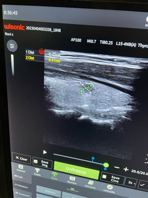 Just A Hello From My Little Thyroid Node Shahrzadsherry Amirgol