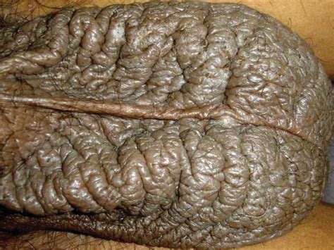 Scrotal Dermatitis Can We Consider It As A Separate Entity Pmc