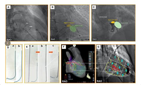 A One Pacing Lead Is Placed In The His Bundle Region An Anatomical