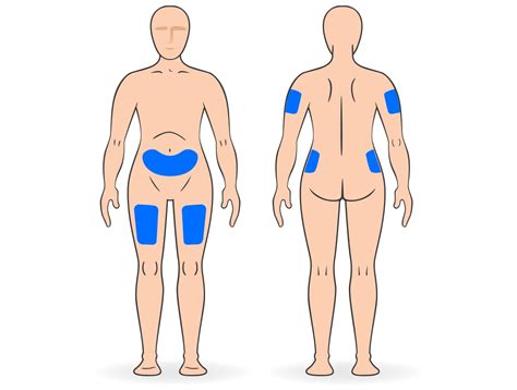 Subcutaneous B Po02 064 Sub Serratus Implantation Of The Subcutaneous