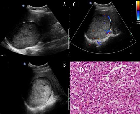 Ultrasound Imaging In The Diagnosis Of Benign And Suspicious Adrenal