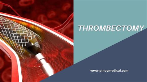Thrombectomy Price In The Philippines 2026 — Pinoymedical